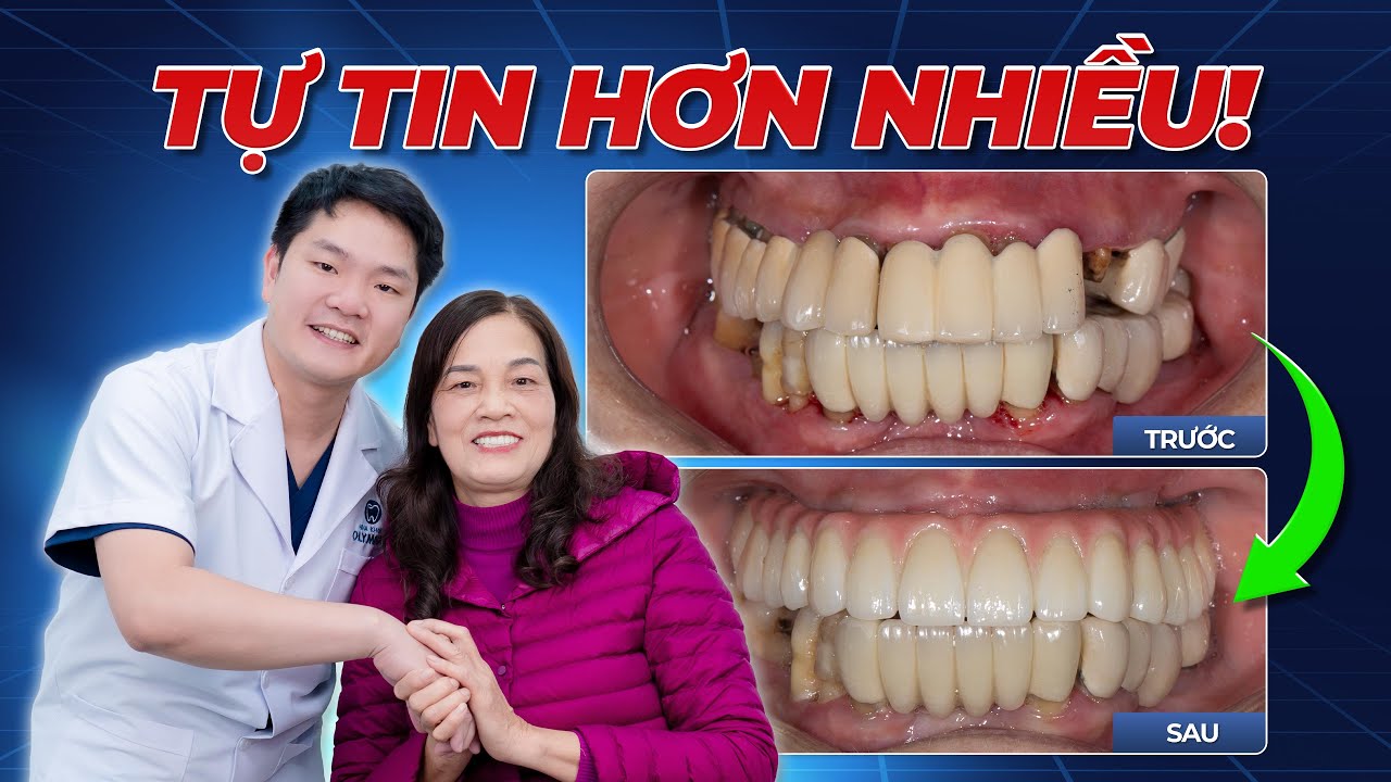 Implant toàn hàm: Khi nào nên làm?